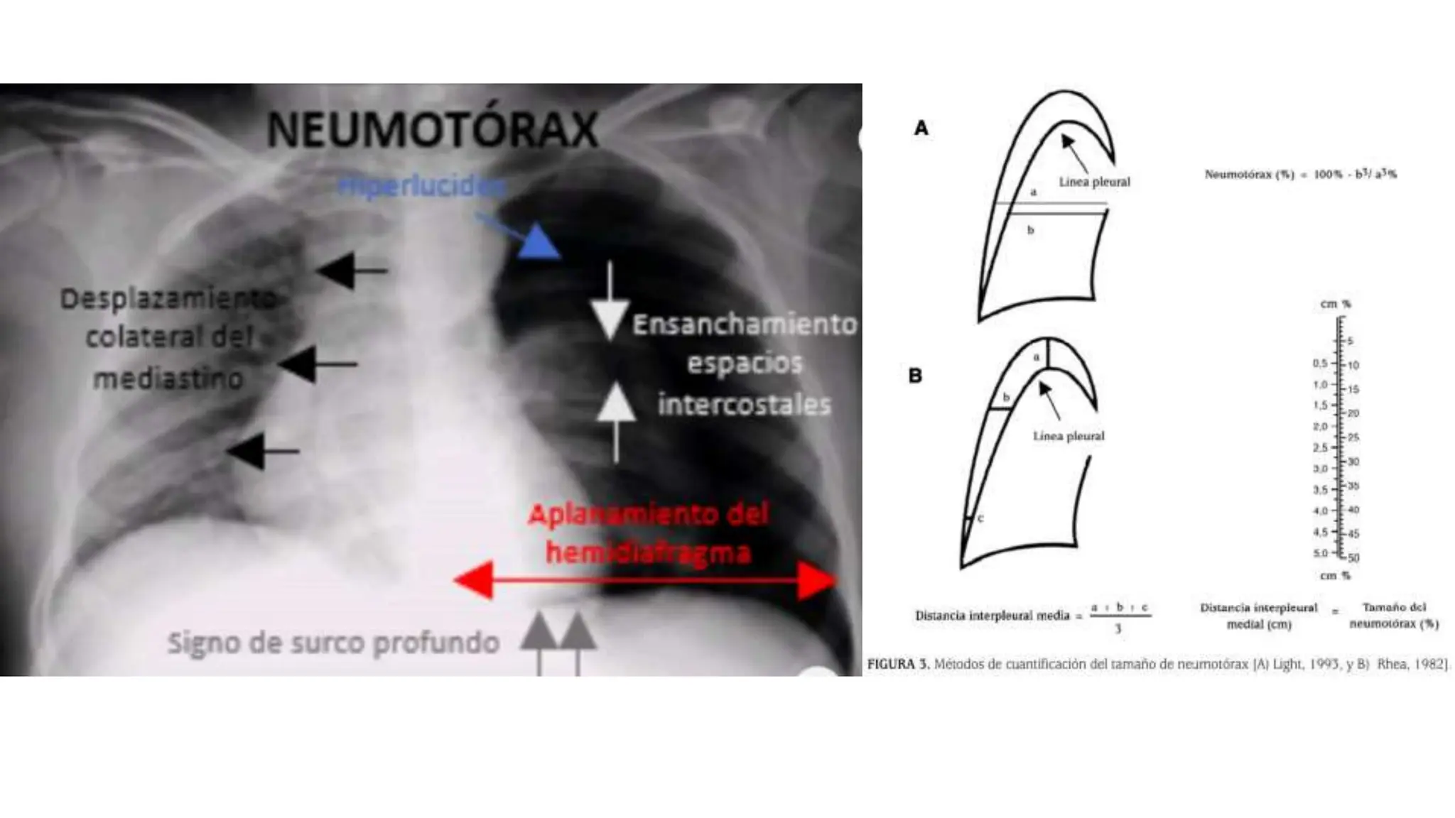 Trauma de torax; Neumotorax a tension, taponamiento cardiaco, por ...