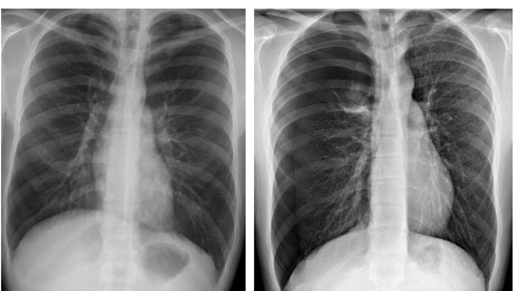 Trauma de torax; Neumotorax a tension, taponamiento cardiaco, por ...
