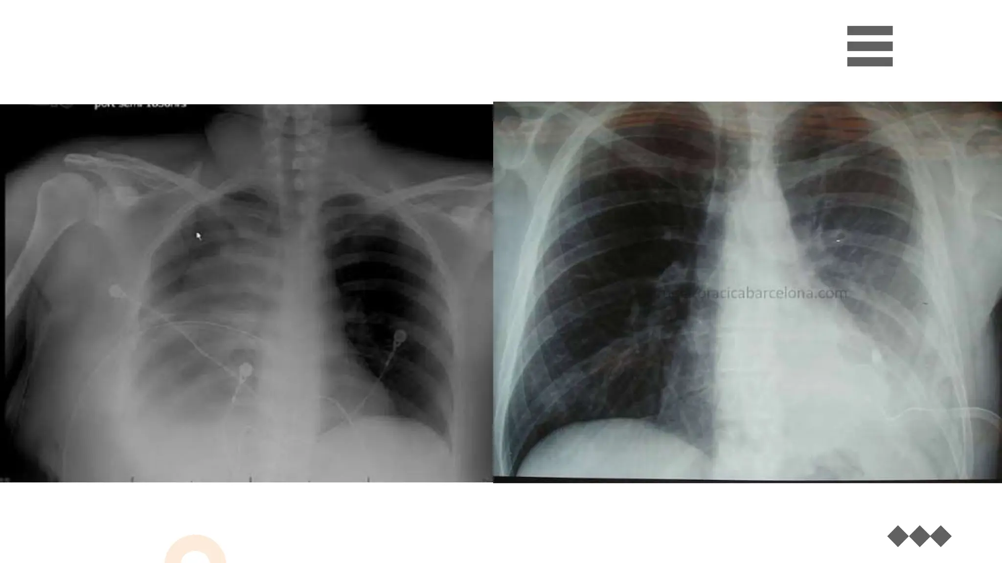 Trauma de torax; Neumotorax a tension, taponamiento cardiaco, por ...
