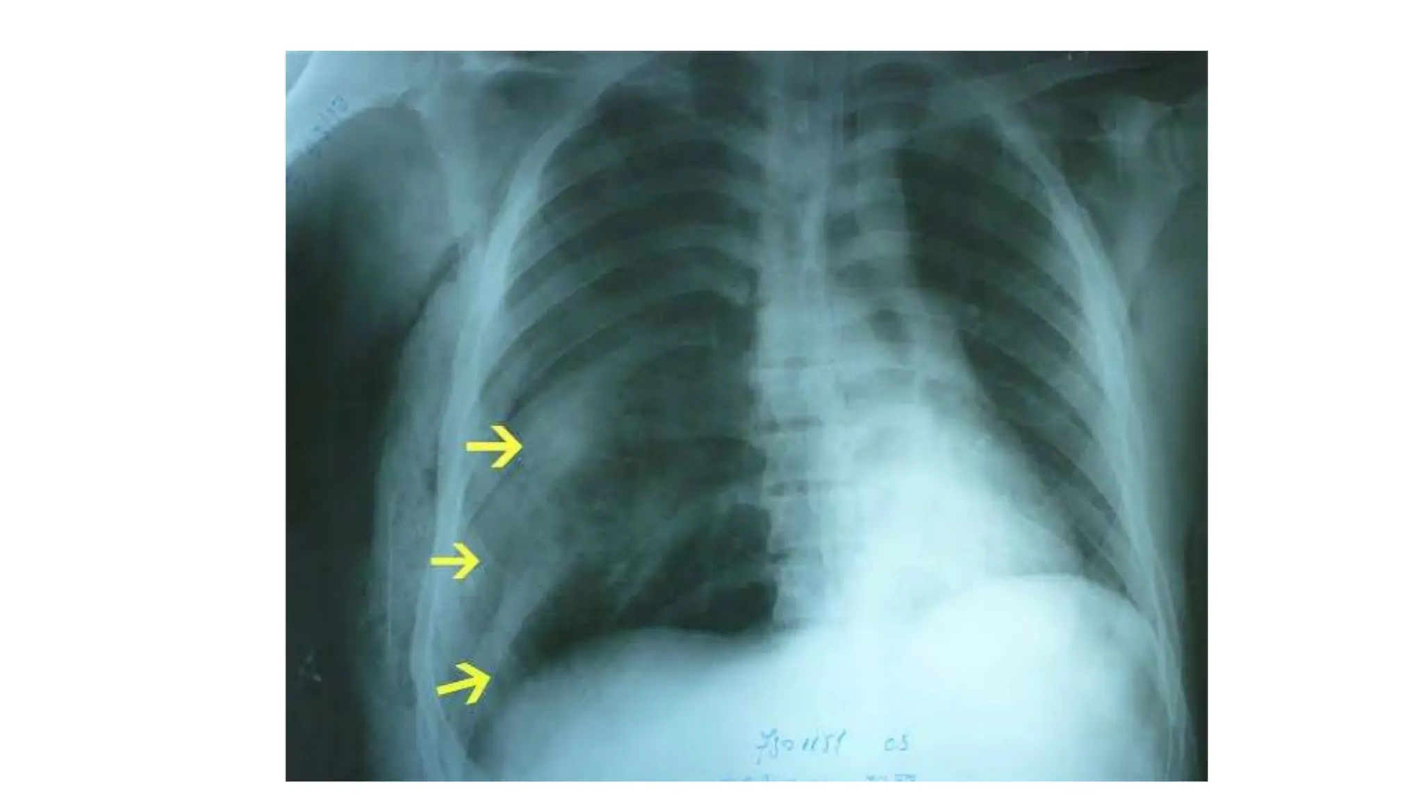 Trauma de torax; Neumotorax a tension, taponamiento cardiaco, por ...