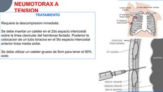 trauma de tórax - abierto/Cerrado - Tipos | PPTX