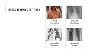 Traumatismo de torax, tipos y mecanismos | PPTX