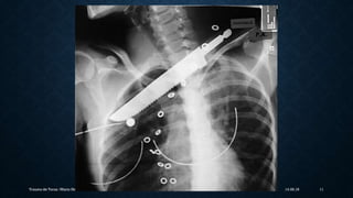 Trauma de torax 07 04-2018