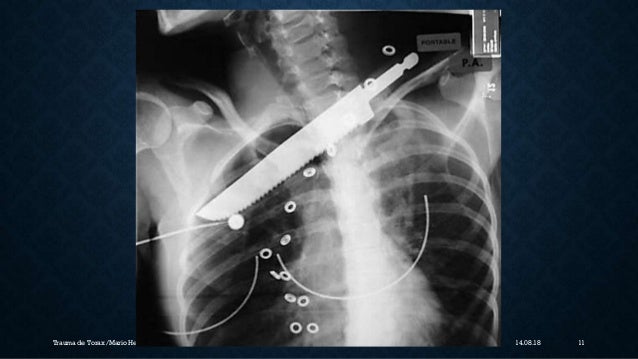 Trauma de torax 07 04-2018