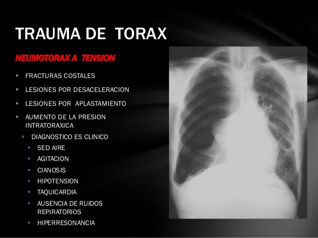 Trauma de torax