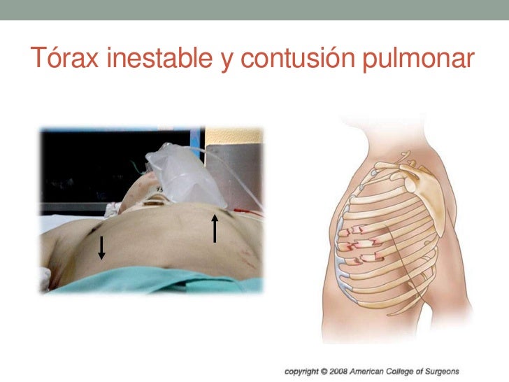 Trauma de tórax