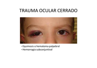 Trauma Ocular.pptx
