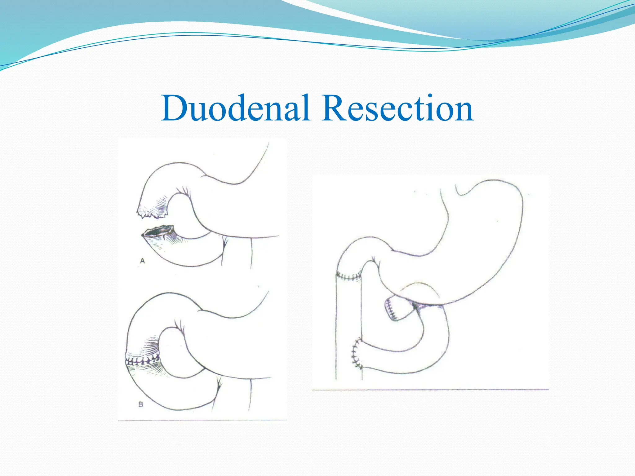 Diagnostico y manejo del Trauma duodenal.pptx