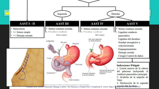 Trauma en páncreas y trauma en vísceras huecas | PPTX