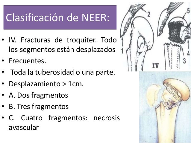 Traumatismo, inflamación,callo blando,callo duro, remodelación,tiempo…