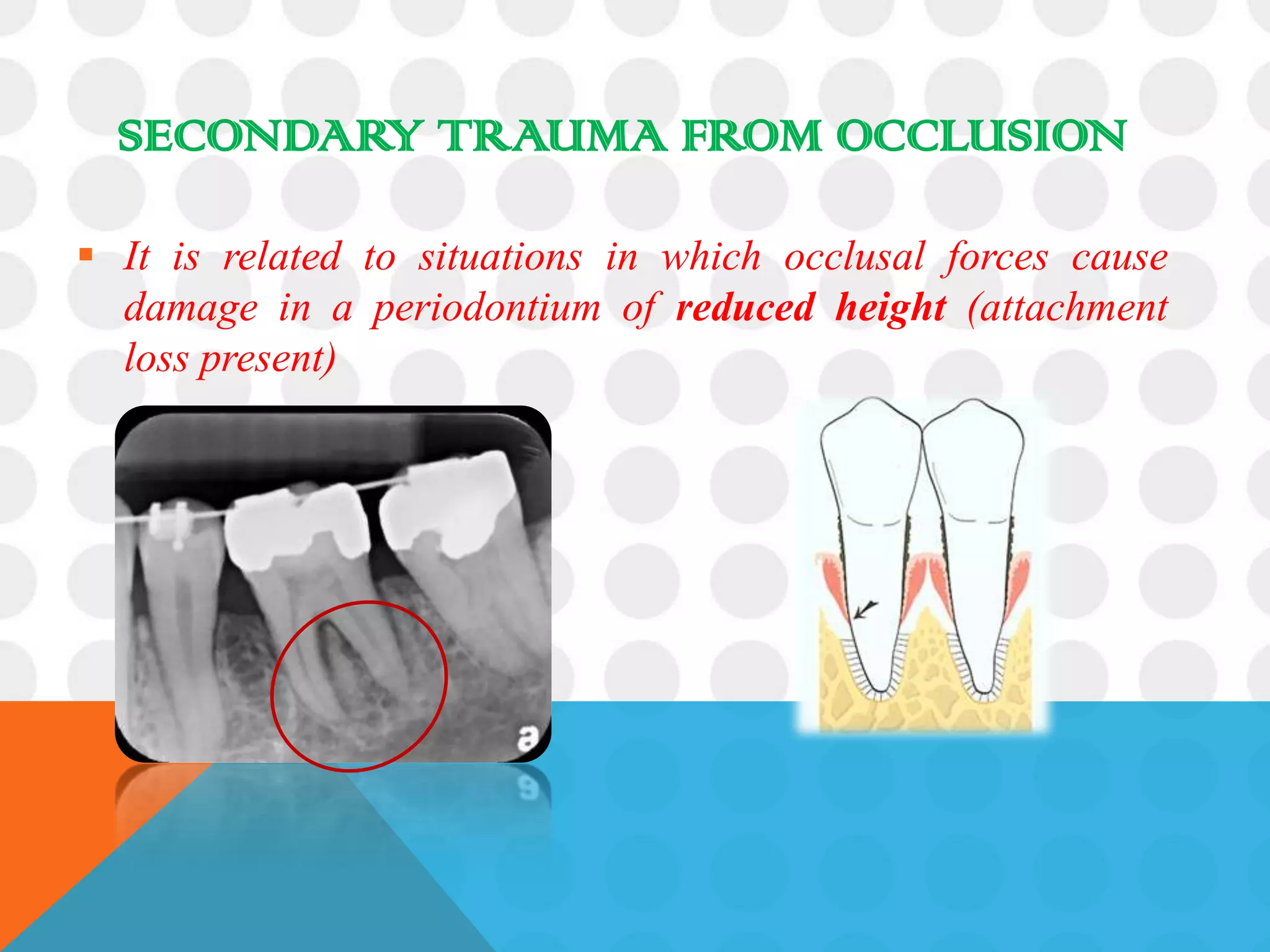 Trauma from occlusion | PPTX