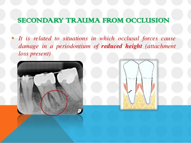 Trauma from occlusion