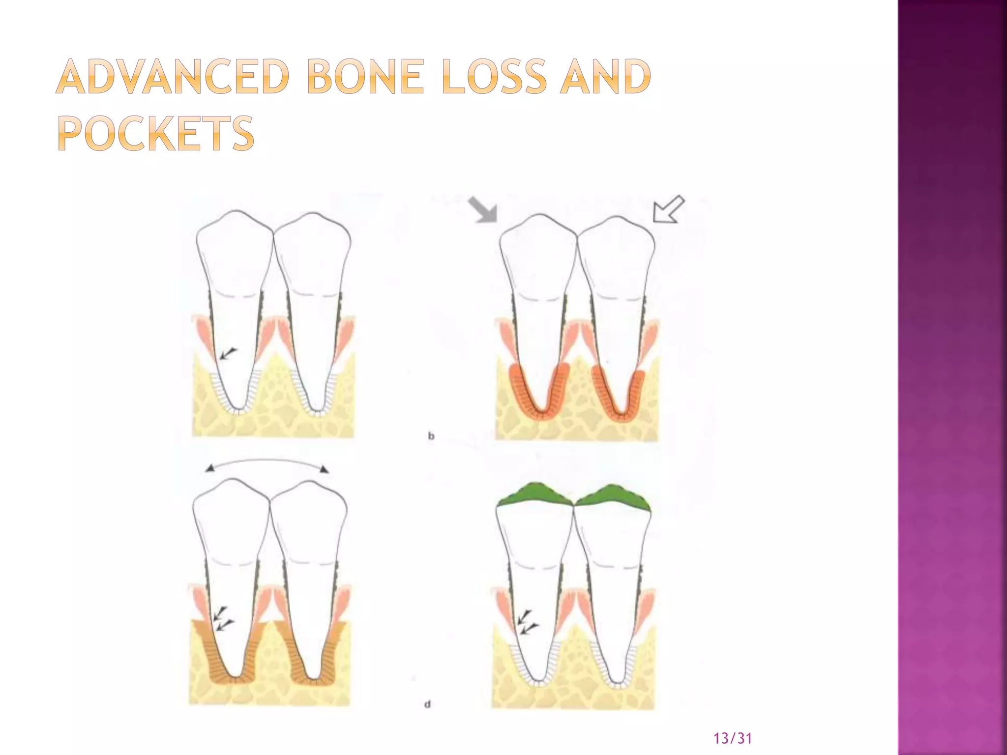 Trauma from occlusion | PPTX