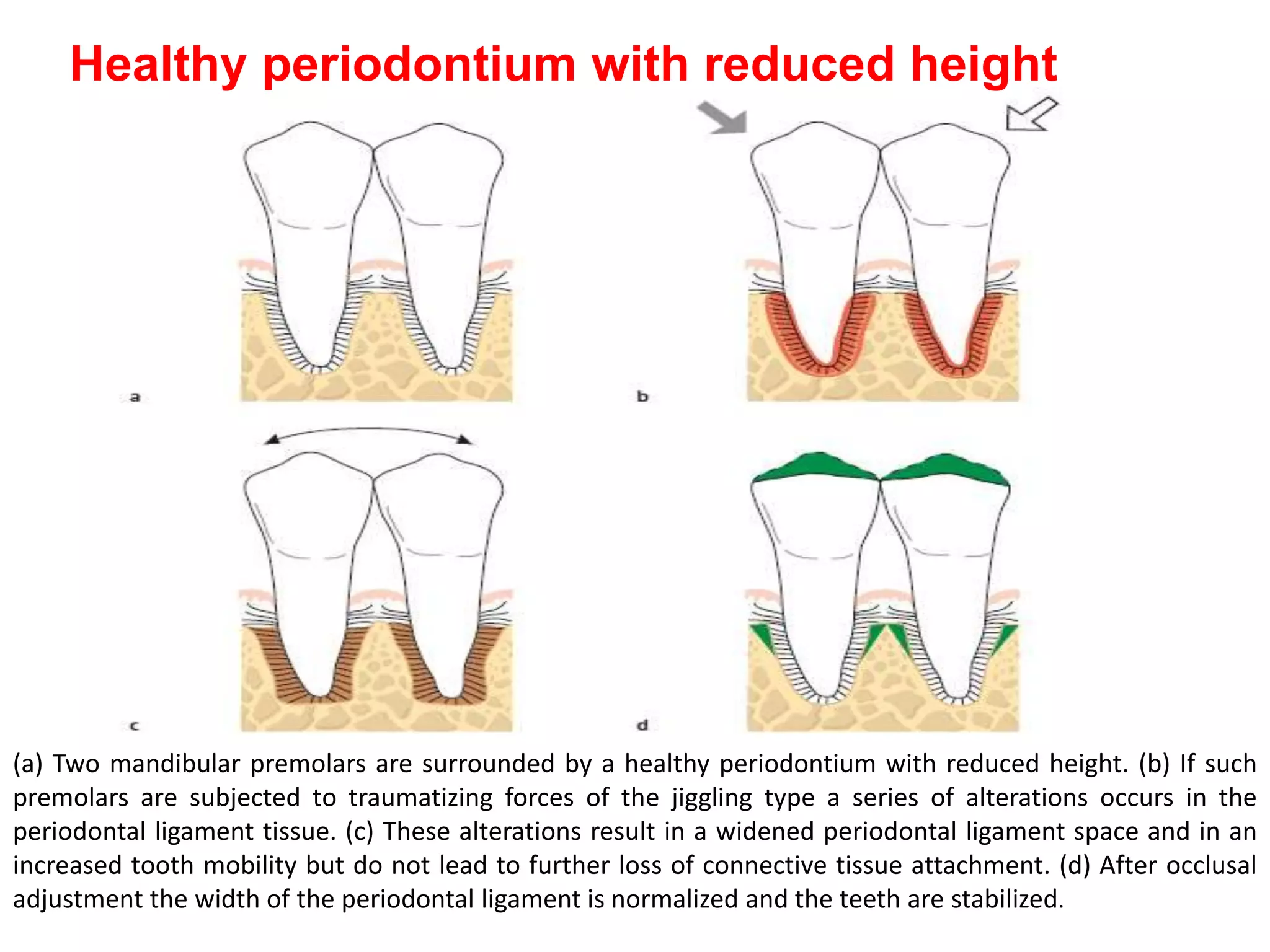 Trauma from occlusion | PPTX
