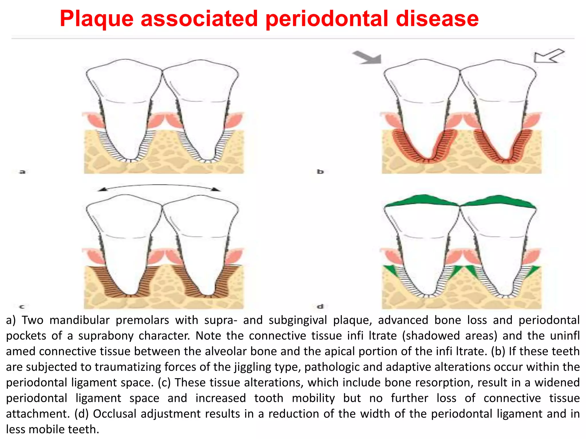 Trauma from occlusion | PPTX