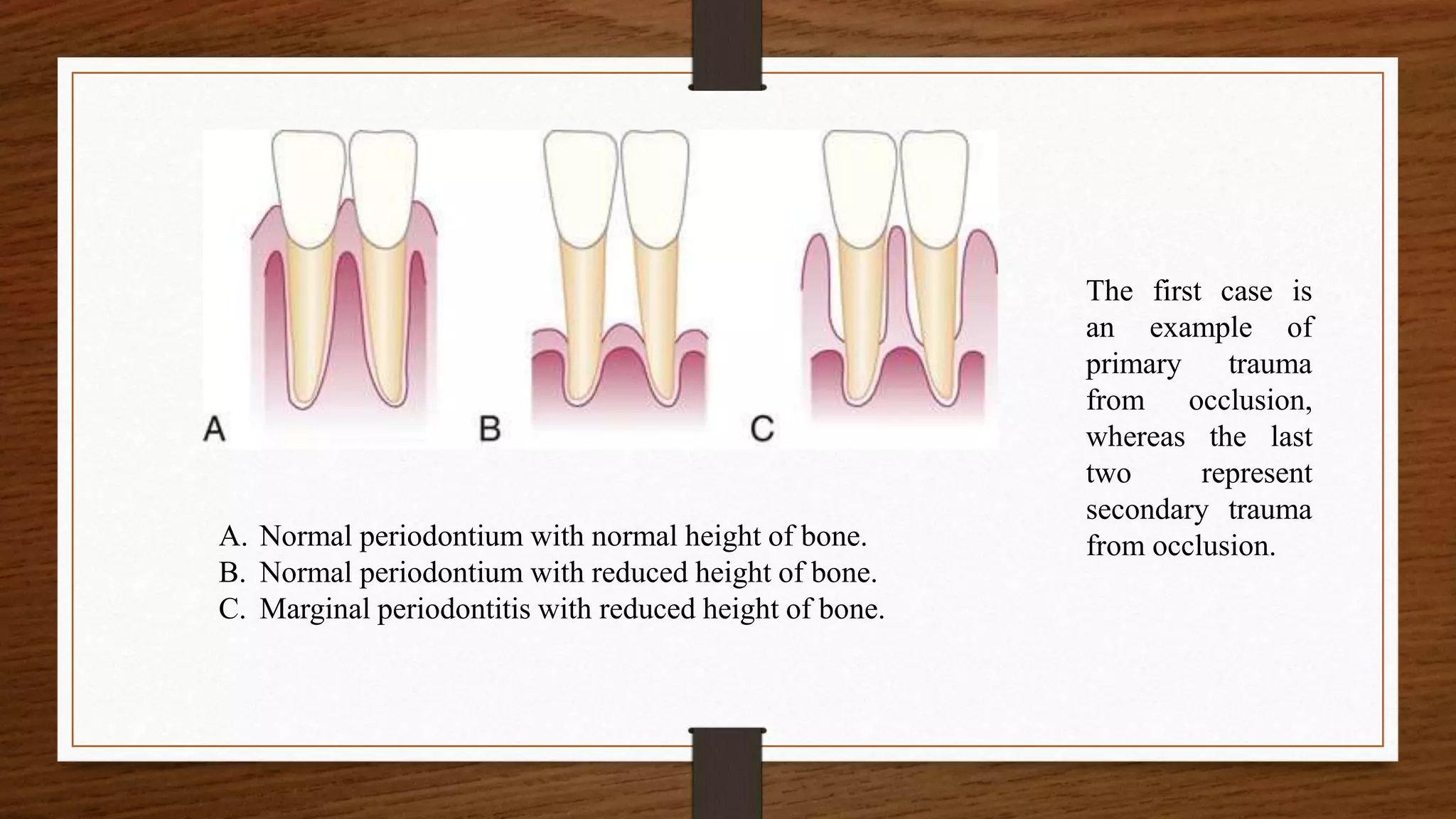 Trauma from occlusion | PPTX