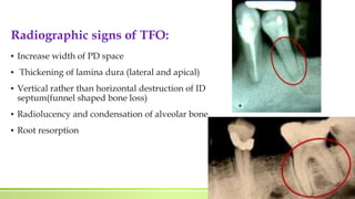 Trauma from occlusion | PPTX