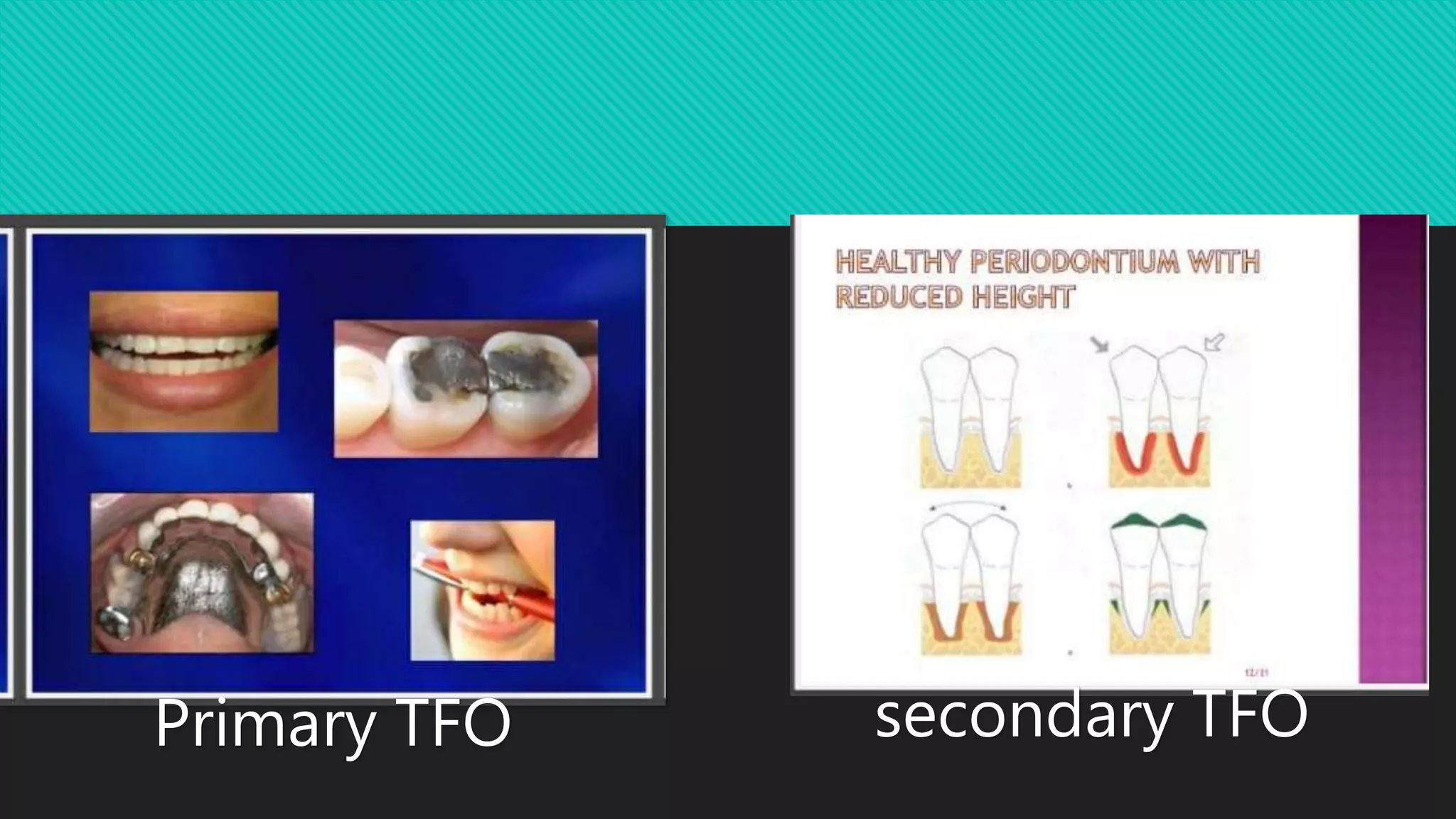 Trauma from occlusion | PPTX