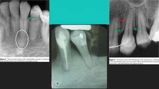 Trauma from occlusion | PPTX | Dental Health | Diseases and Conditions