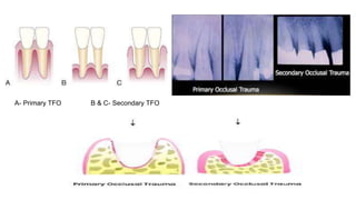 Trauma from occlusion.ppt