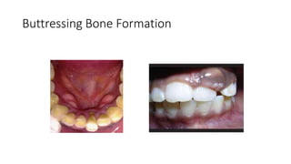 Trauma from occlusion.ppt | Dental Health | Diseases and Conditions