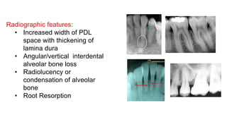 Trauma from occlusion.ppt