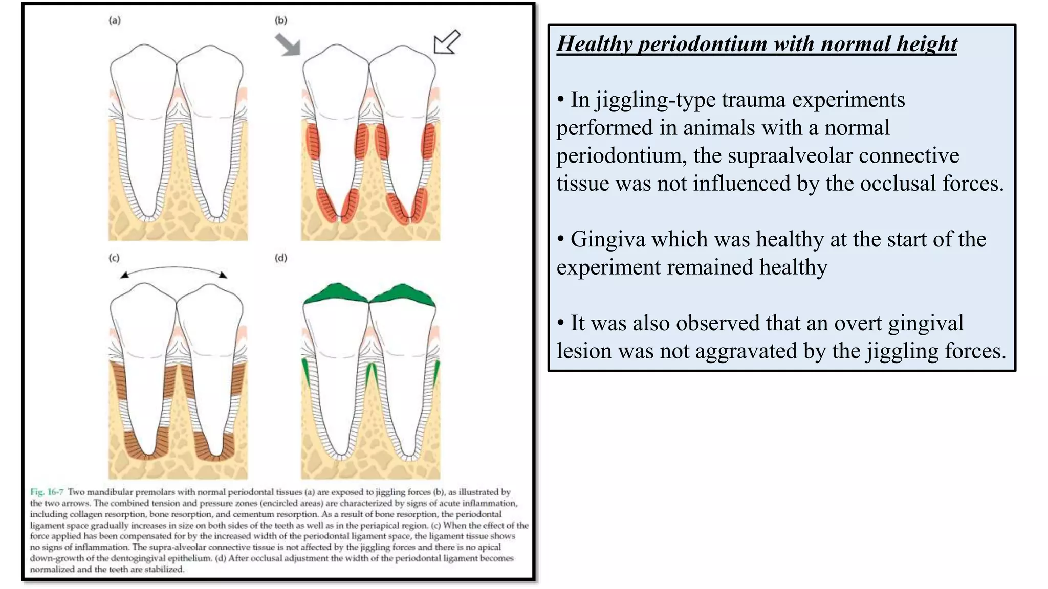 Trauma from occlusion in Periodontics.pptx