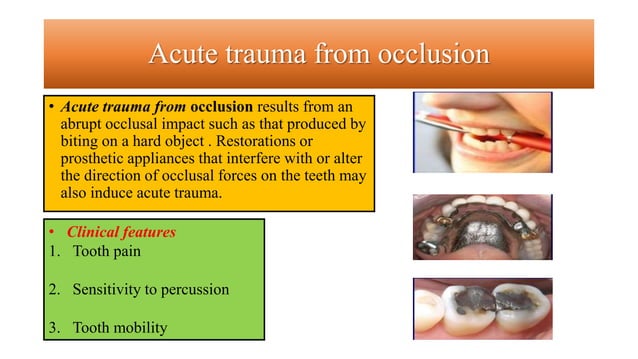 Trauma from occlusion in Periodontics.pptx | Dental Health | Diseases ...