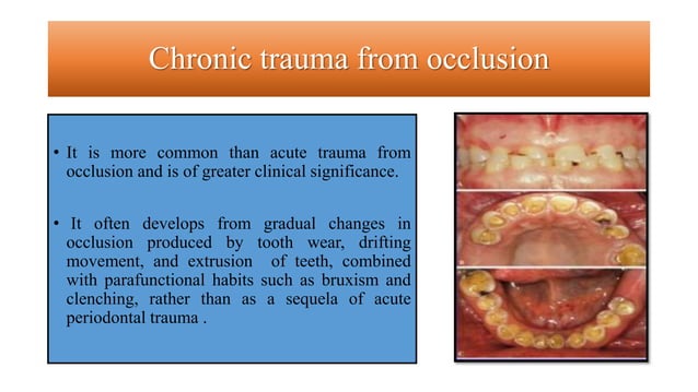 Trauma from occlusion in Periodontics.pptx | Dental Health | Diseases ...