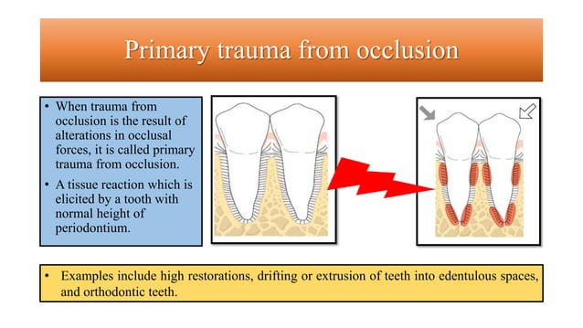 Trauma from occlusion in Periodontics.pptx | Dental Health | Diseases ...