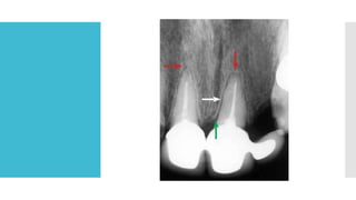 TRAUMA FROM OCCLUSION- APOORVA DHOPTE.pptx