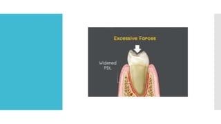 TRAUMA FROM OCCLUSION- APOORVA DHOPTE.pptx