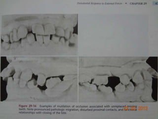 trauma from occlusion new.pptx