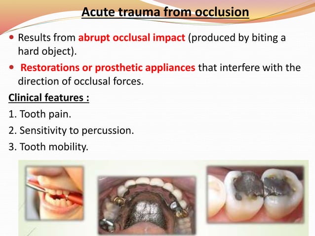 Trauma from occlusion. | PPTX