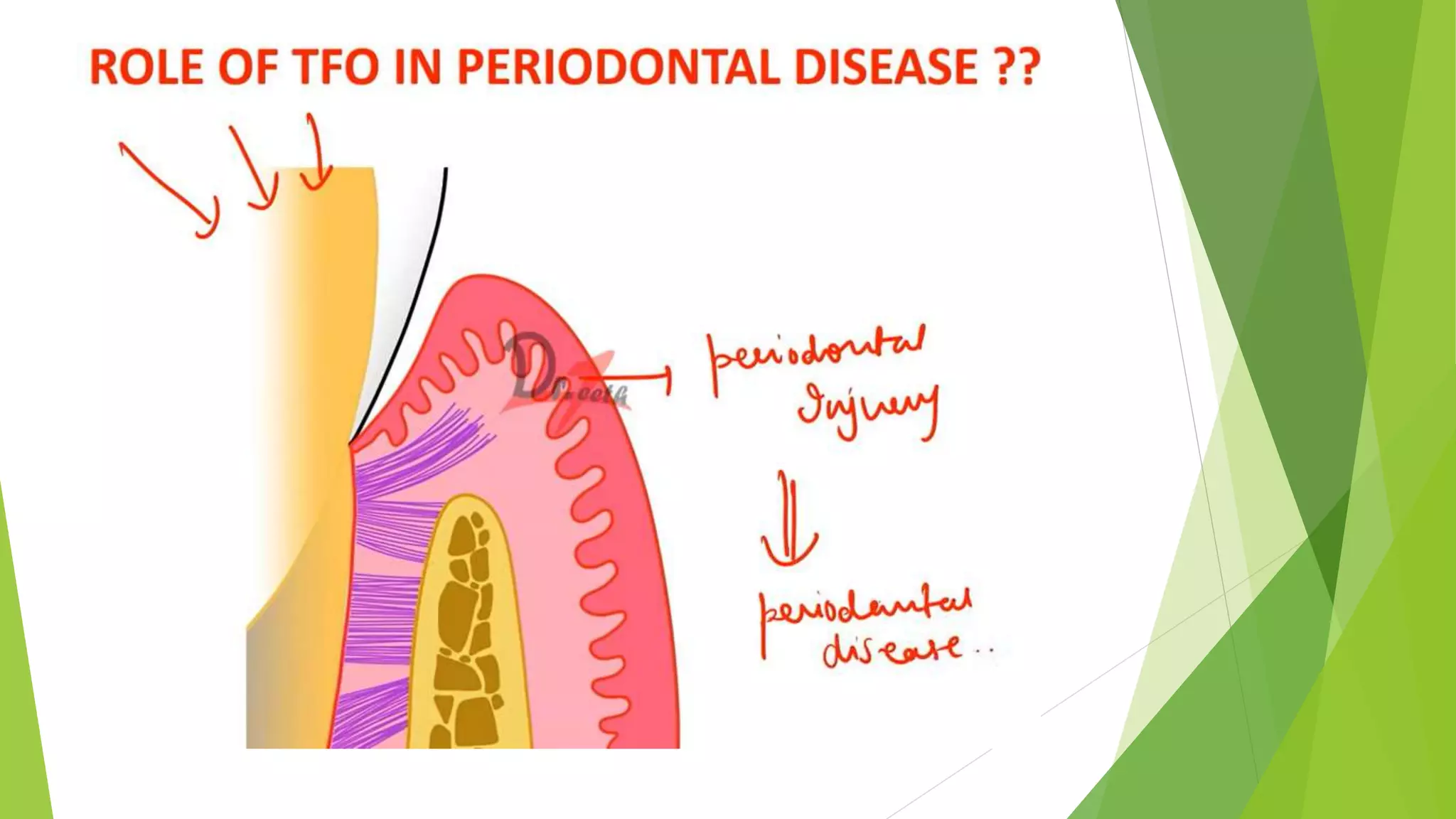 trauma from occlusion (TFO).pptx