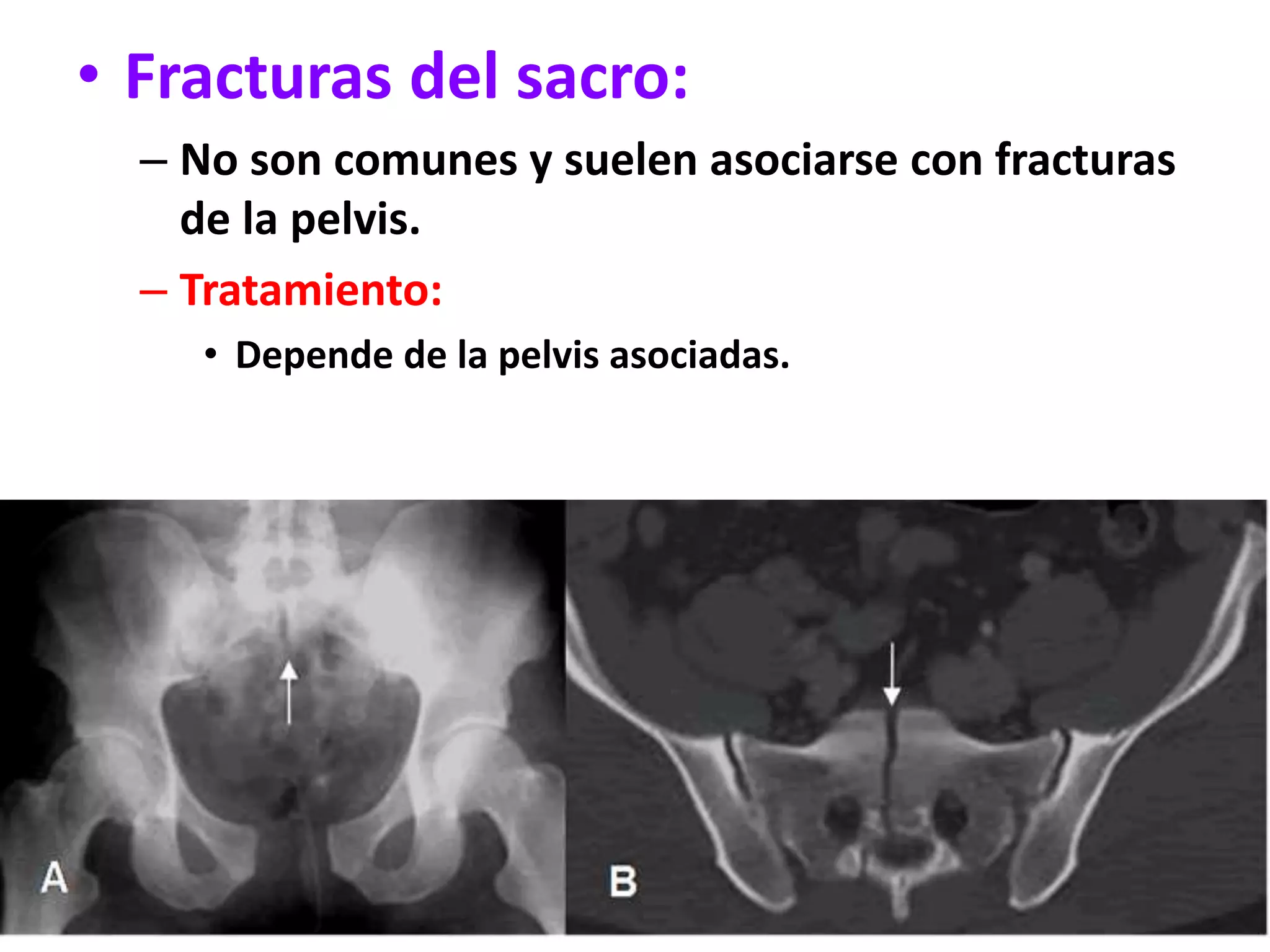 Trauma lesiones de la pelvis | PPTX
