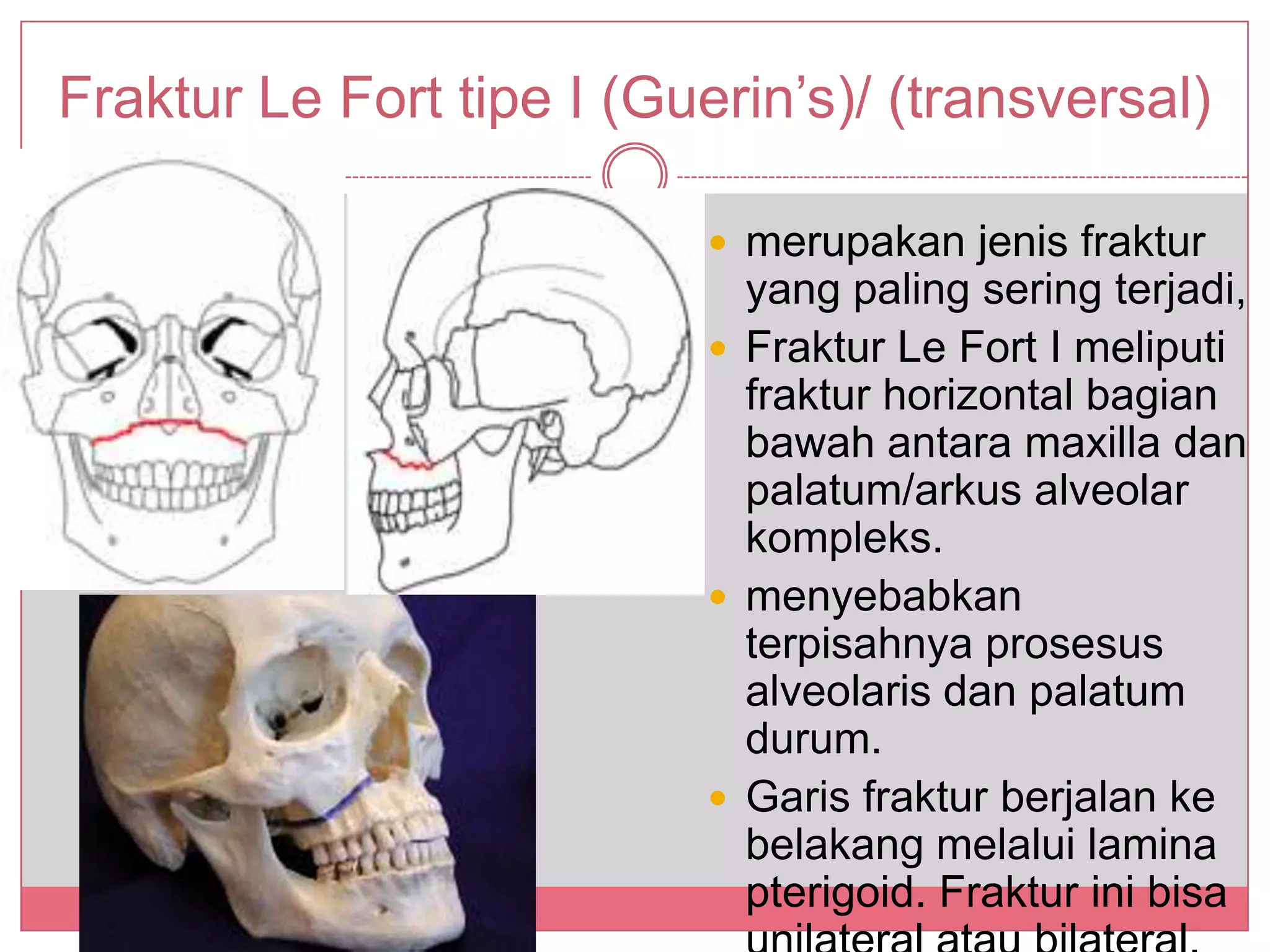 Trauma maksilofasial | PPTX