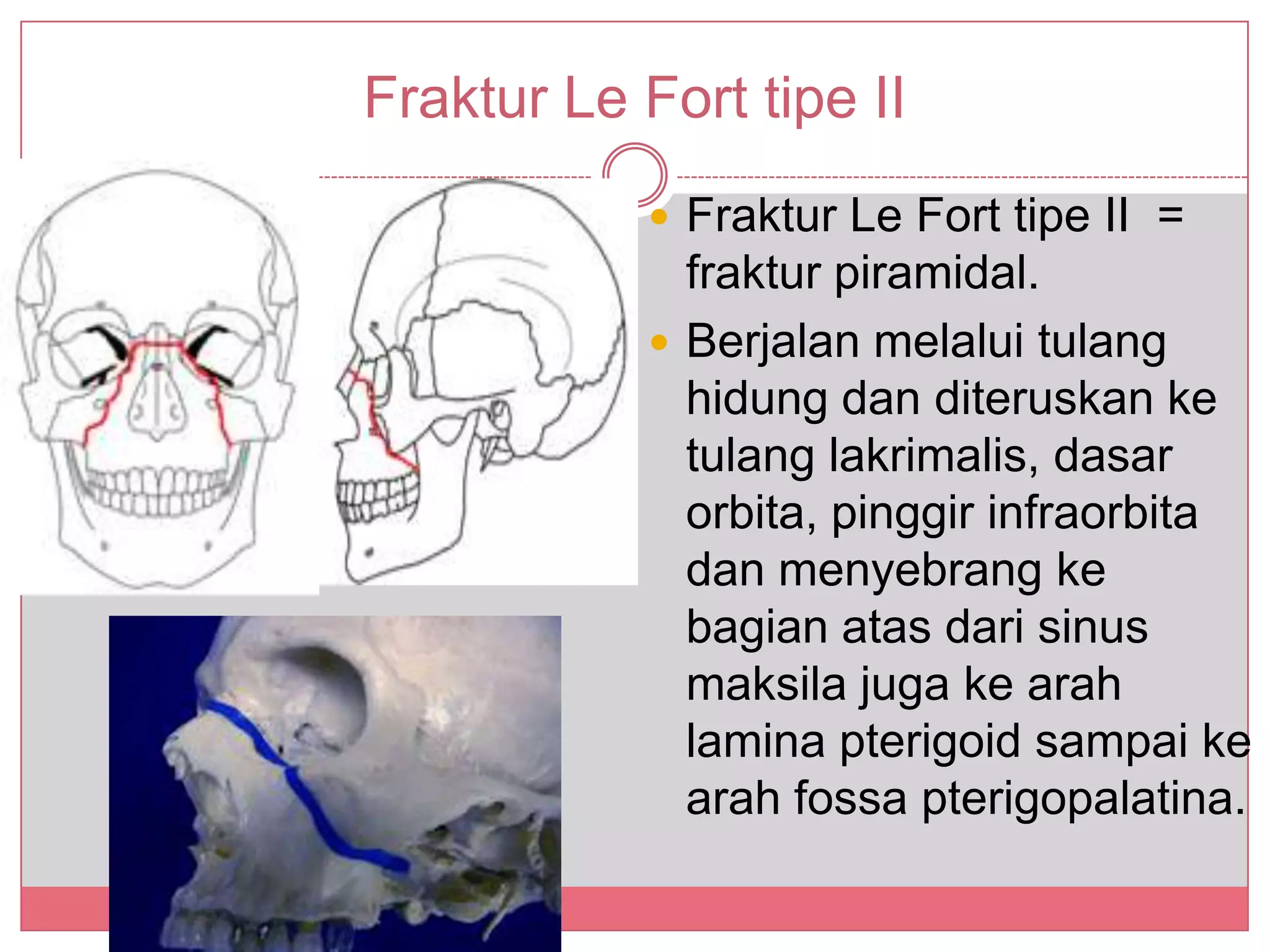 Trauma maksilofasial | PPTX