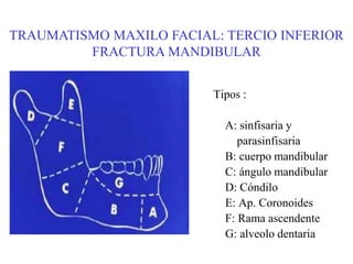 Trauma maxilofacial | PPT