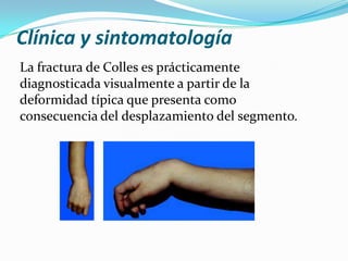 FRACTURA DE POUTEAU COLLES | PPTX