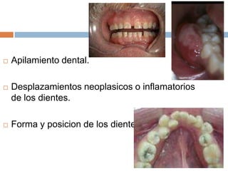 Trauma oclusal | PPTX