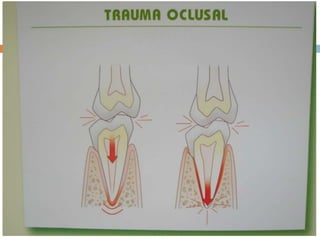 Trauma oclusal | PPTX