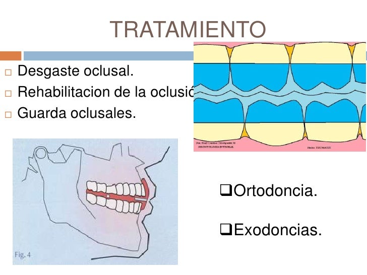 Trauma oclusal