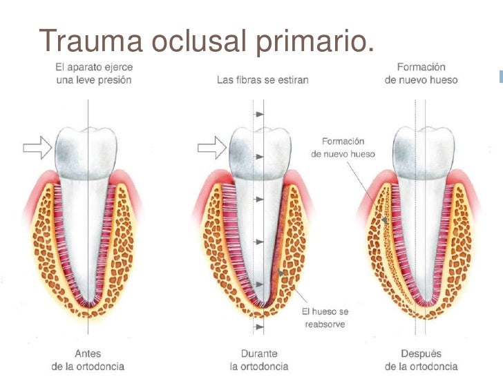 Trauma Oclusal