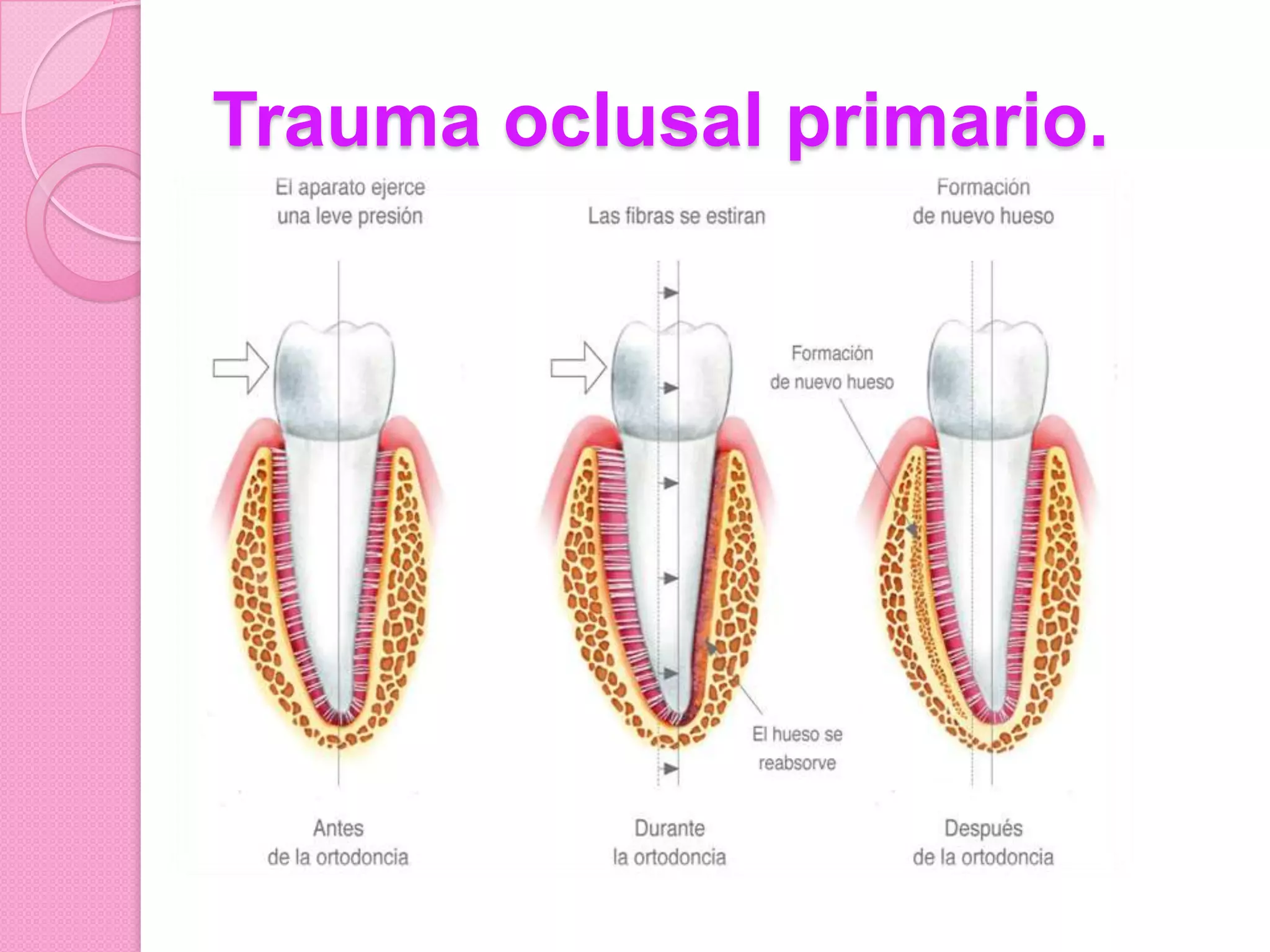 Trauma oclusal