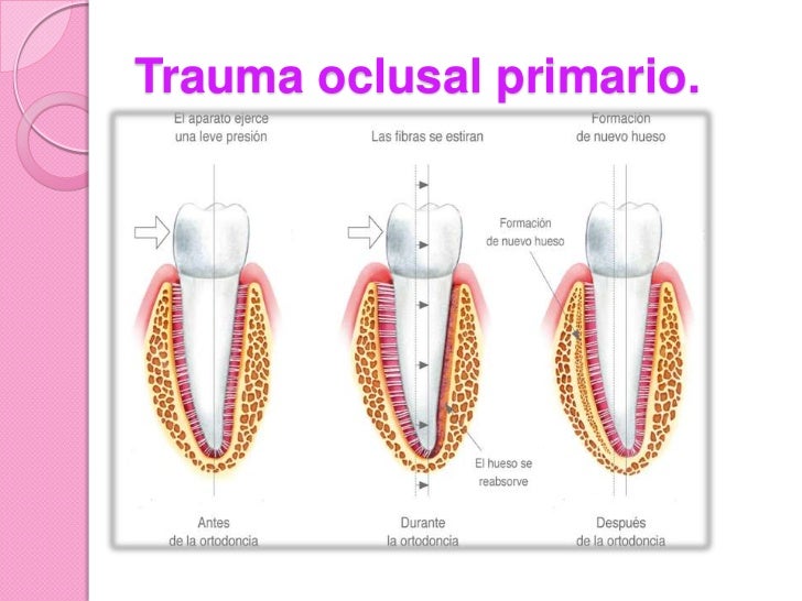 Trauma oclusal
