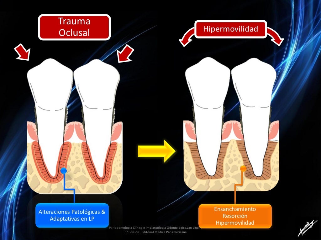 Trauma Oclusal - Terapéutica Periodontal -Germán Alejandro Aguilar Ca…