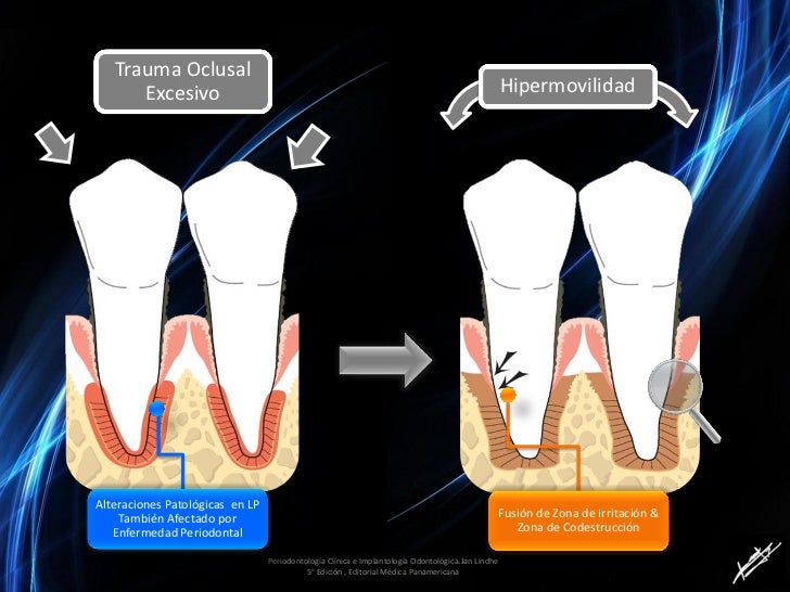 Trauma Oclusal - Terapéutica Periodontal -Germán Alejandro Aguilar Ca…