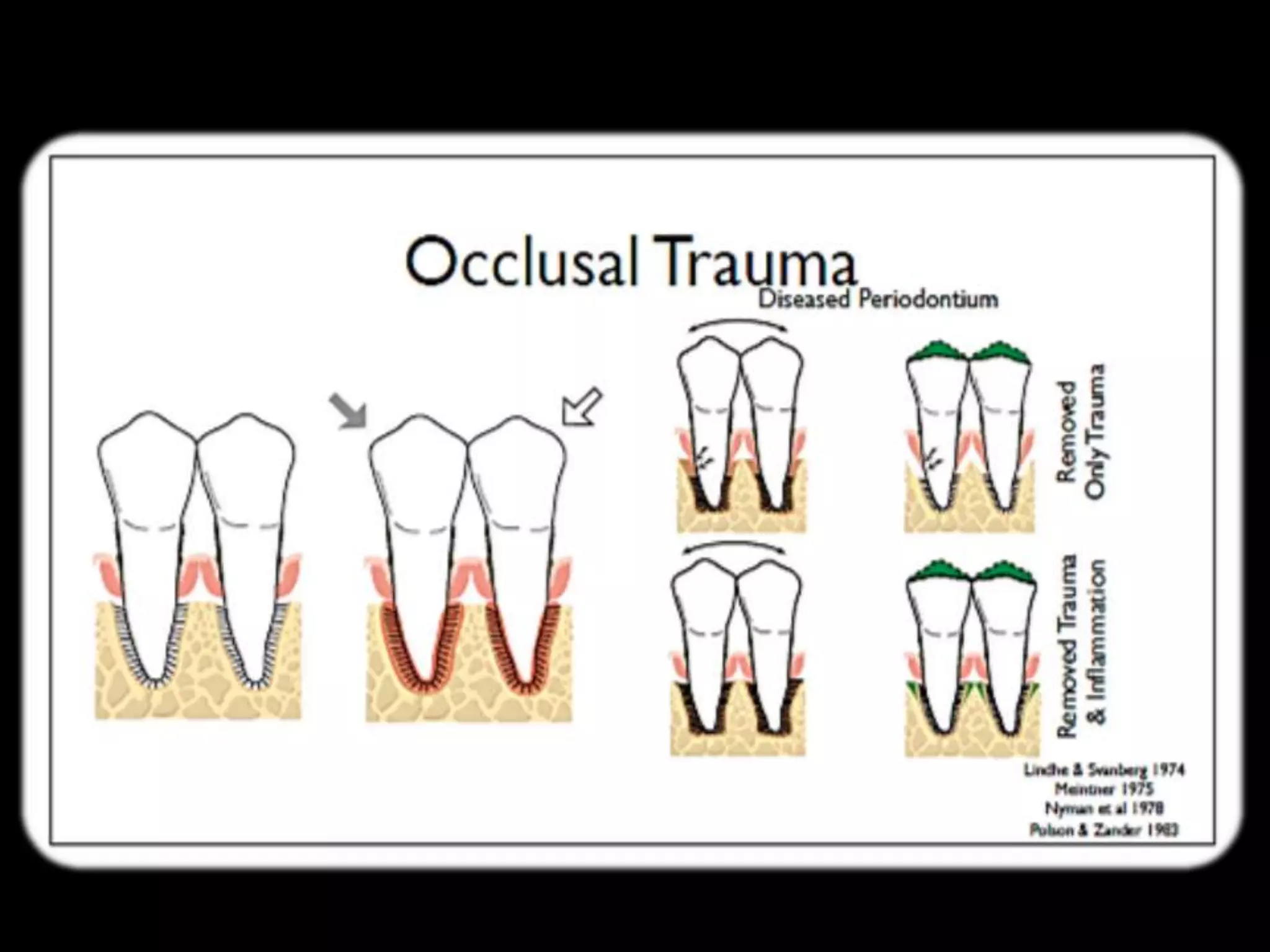 Trauma oclusal orto perio Dr. Nelson Mendoza | PPTX