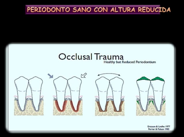 Trauma oclusal orto perio Dr. Nelson Mendoza | PPTX | Death, Injury, or ...